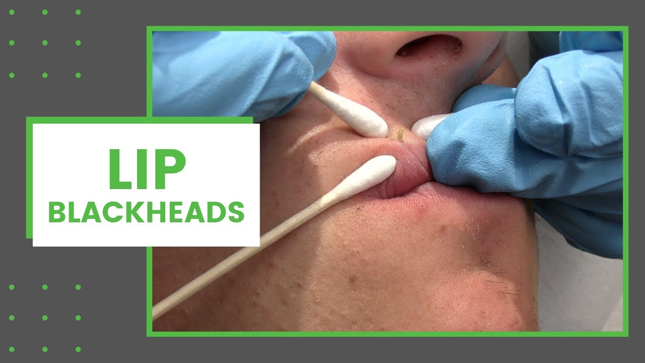 Lip Blackhead Treatment Video Spotter
